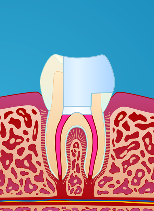 Reinfisert rotfylling – Øvergata Tannklinikk AS